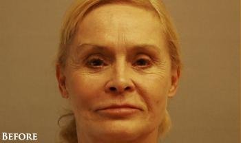 Best Botox Filler/Injections/Treatment Beverly Hills, Los Angeles, CA