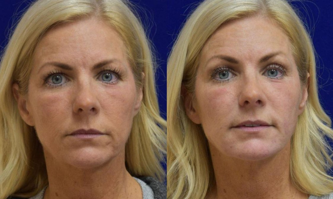 M Lift facelift using Dermal Fillers Beverly Hills, Los Angeles, CA