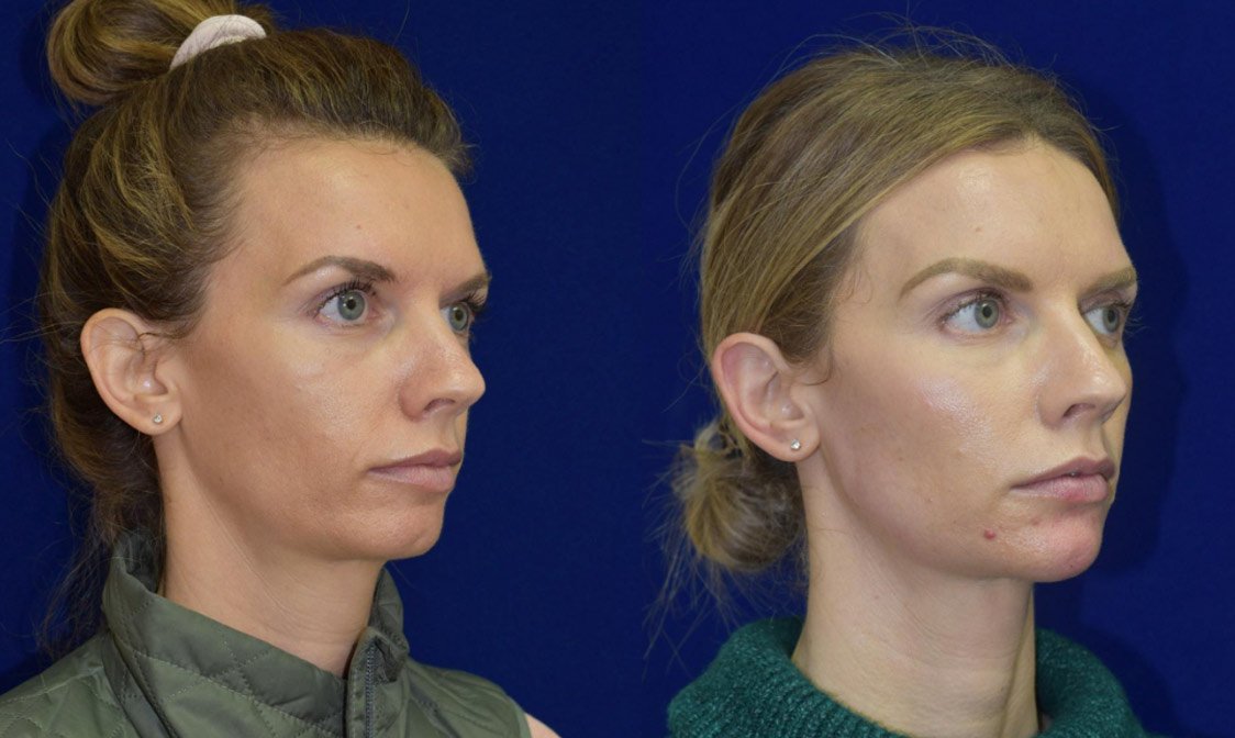 M Lift facelift using Dermal Fillers Beverly Hills, Los Angeles, CA